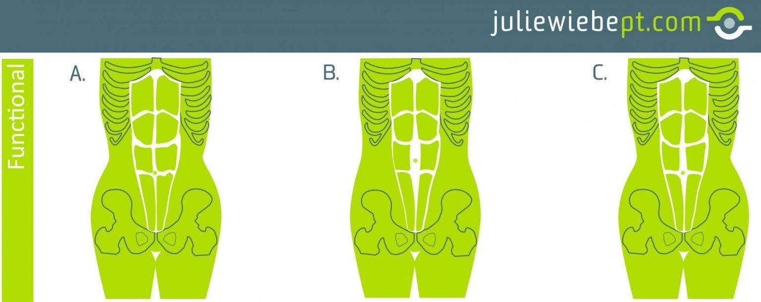 What is a Normal Diastasis?